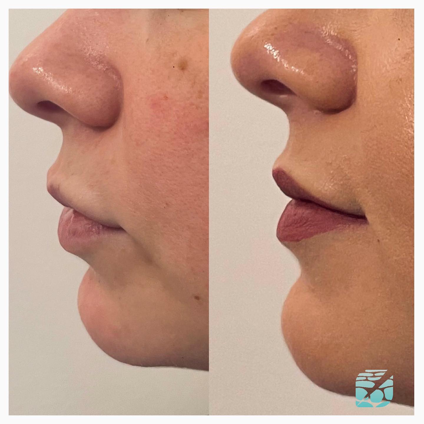 Fillers behandeling | Huid & Laser Kliniek Delft