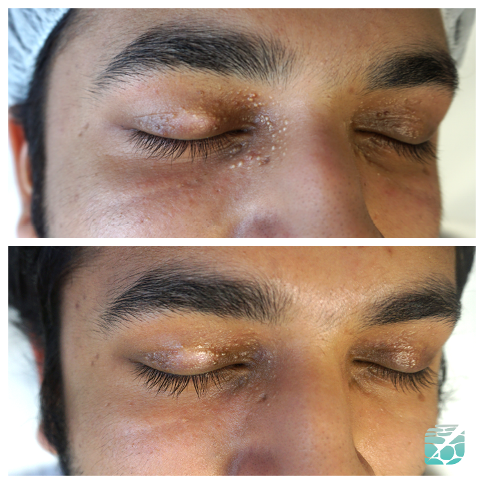 Acne Comedonica behandeling door Huid & Laser Kliniek